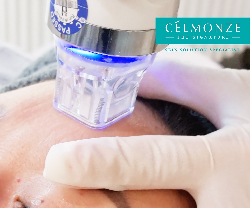Meso-Sculpt Lifting Facial $68 | Celmonze Signature Aesthetic | Beauty ...